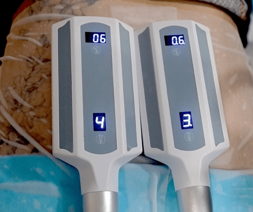 Ultra CoolSculpt - Life clinic